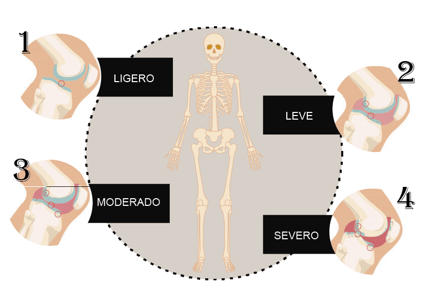 Los 4 Grados de Artrosis según valoración radiológica
